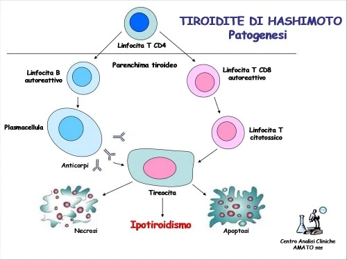 Tiroidite Di Hashimoto